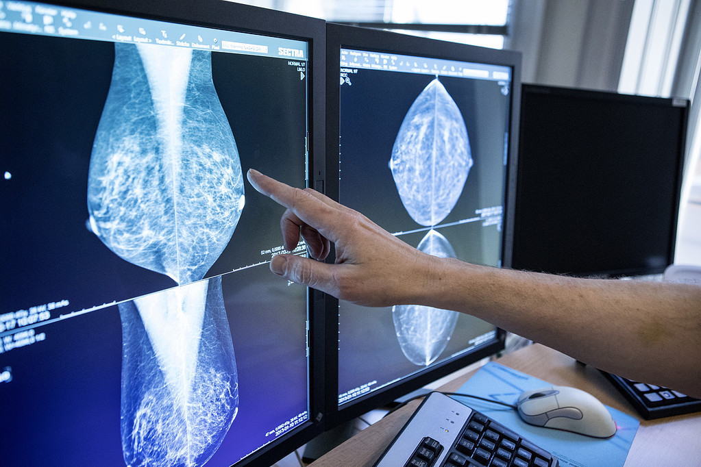 Bröstimplantat utmaning vid mammografi